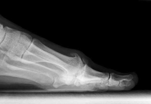 Hallux Rigidus Treatment Peterborough UK | Hallux Rigidus Surgery England