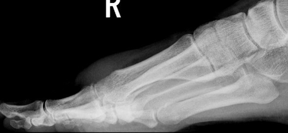 Hallux Rigidus Treatment Peterborough UK | Hallux Rigidus Surgery England