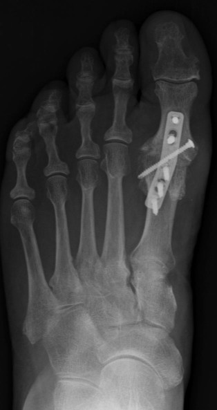 Hallux Rigidus Treatment Peterborough UK | Hallux Rigidus Surgery England